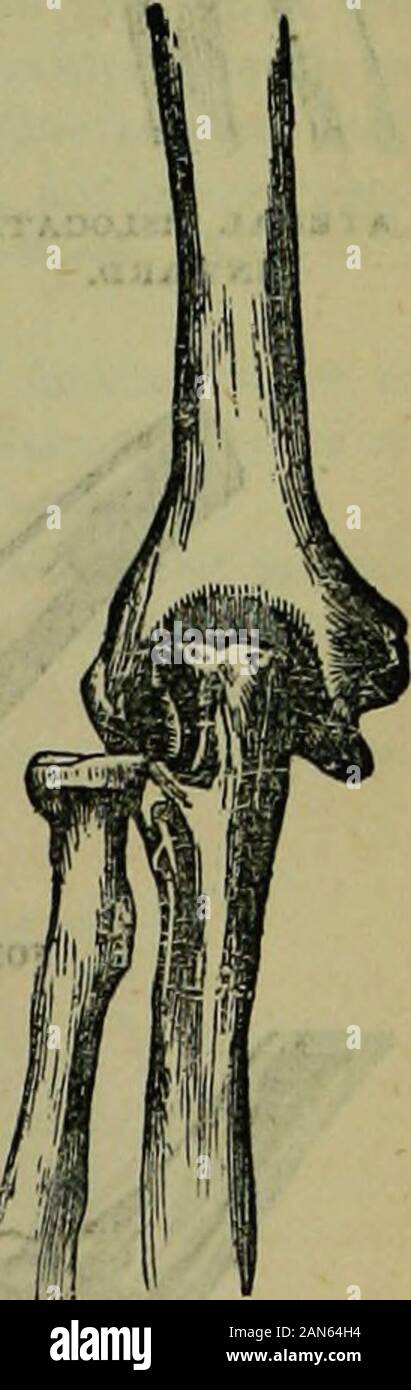 Olecranon process of ulna hi-res stock photography and images - Alamy