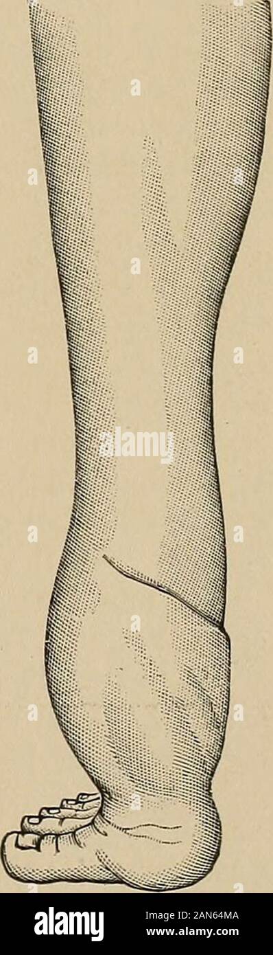 Calcaneal tuberculosis hi-res stock photography and images - Alamy