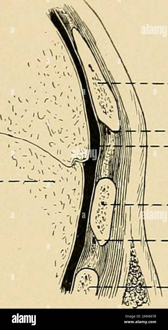First rib fracture hi-res stock photography and images - Alamy