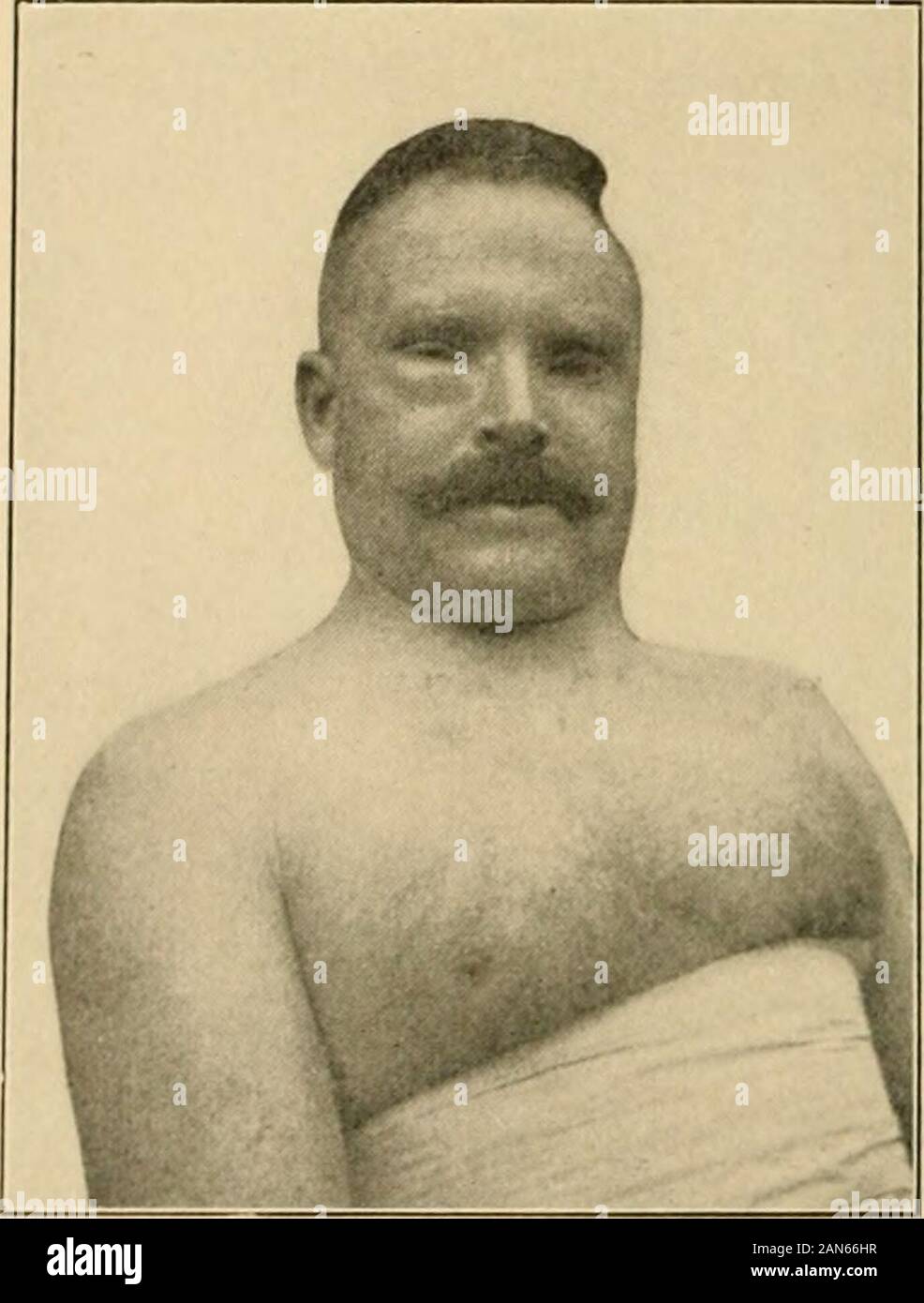 Rib fracture of child hi-res stock photography and images - Alamy