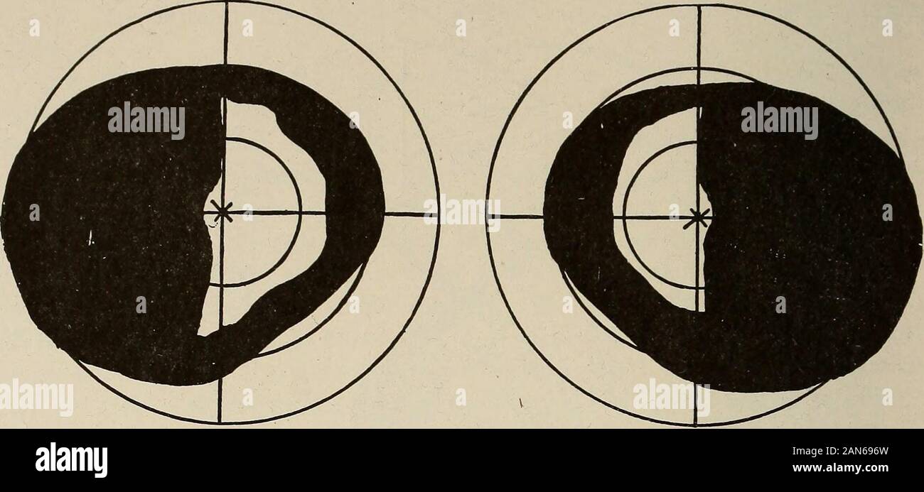 Nervous and mental diseases . -*?+ Crossed fibers.3 3 Uncrossed fibers ...