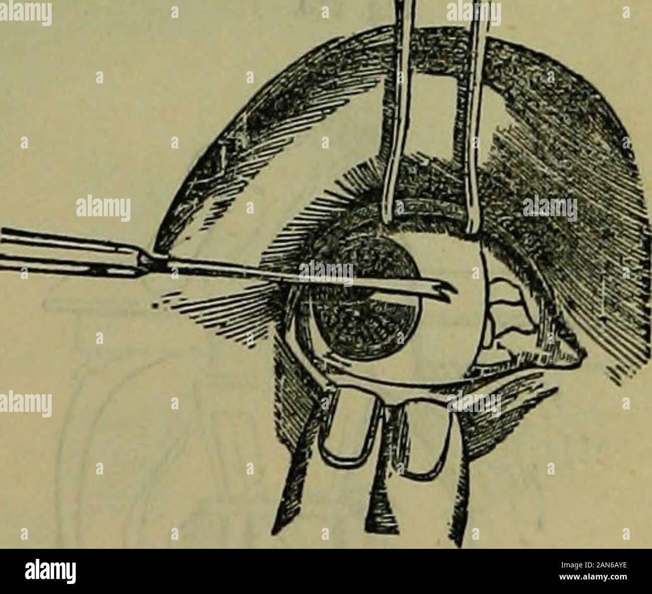 Eye muscle hook hi-res stock photography and images - Alamy