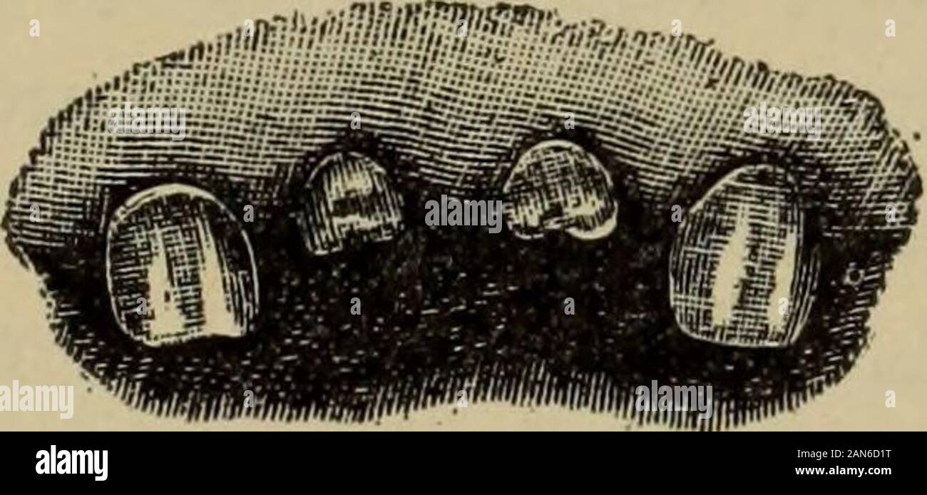 Hereditary syphilis hi-res stock photography and images - Alamy