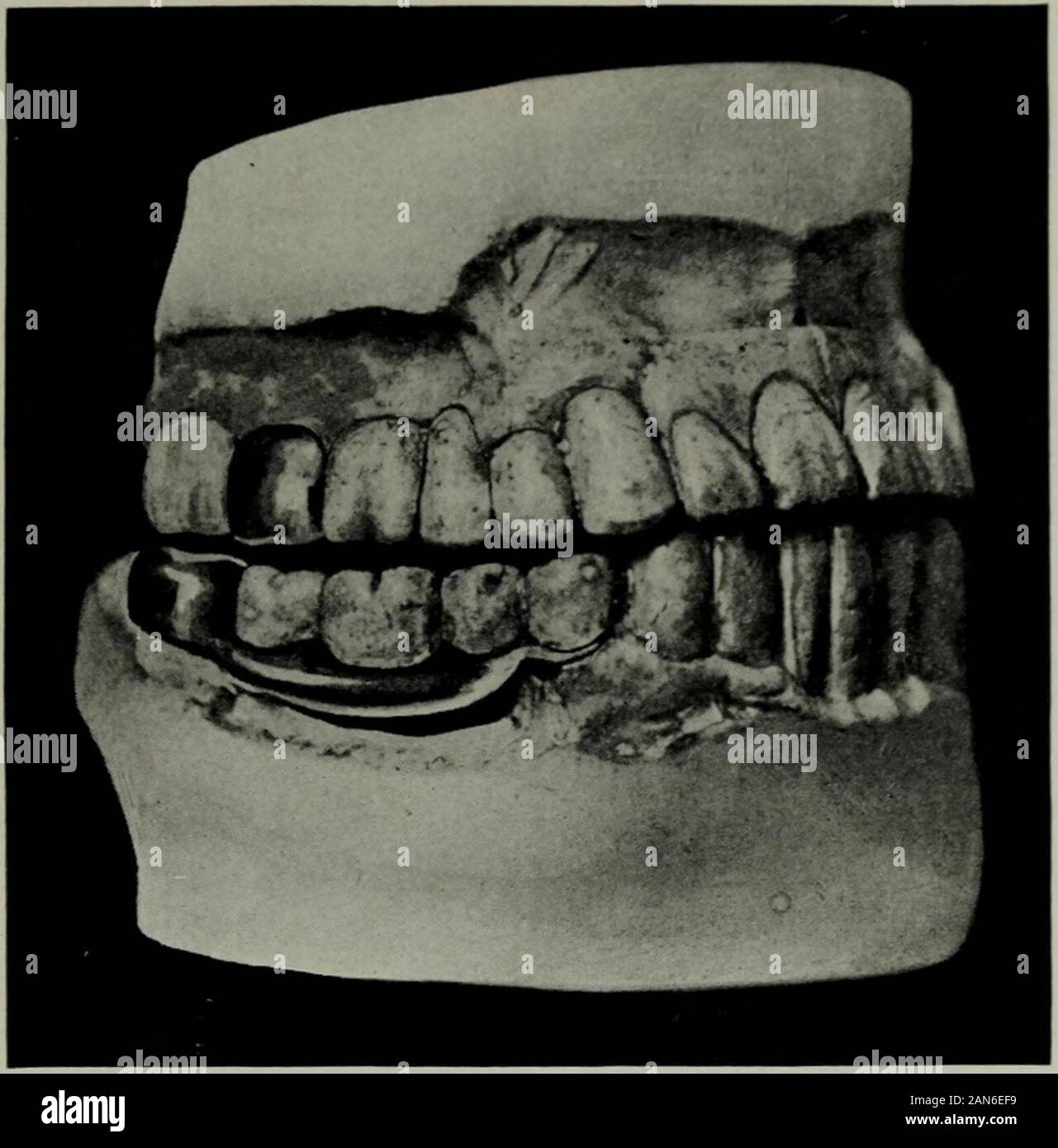 Pyorrhea hi-res stock photography and images - Alamy