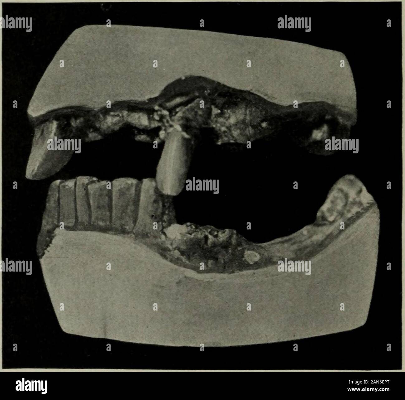 The Dental cosmos . Case I. Right side before treatment. Fig. 2.. Case ...