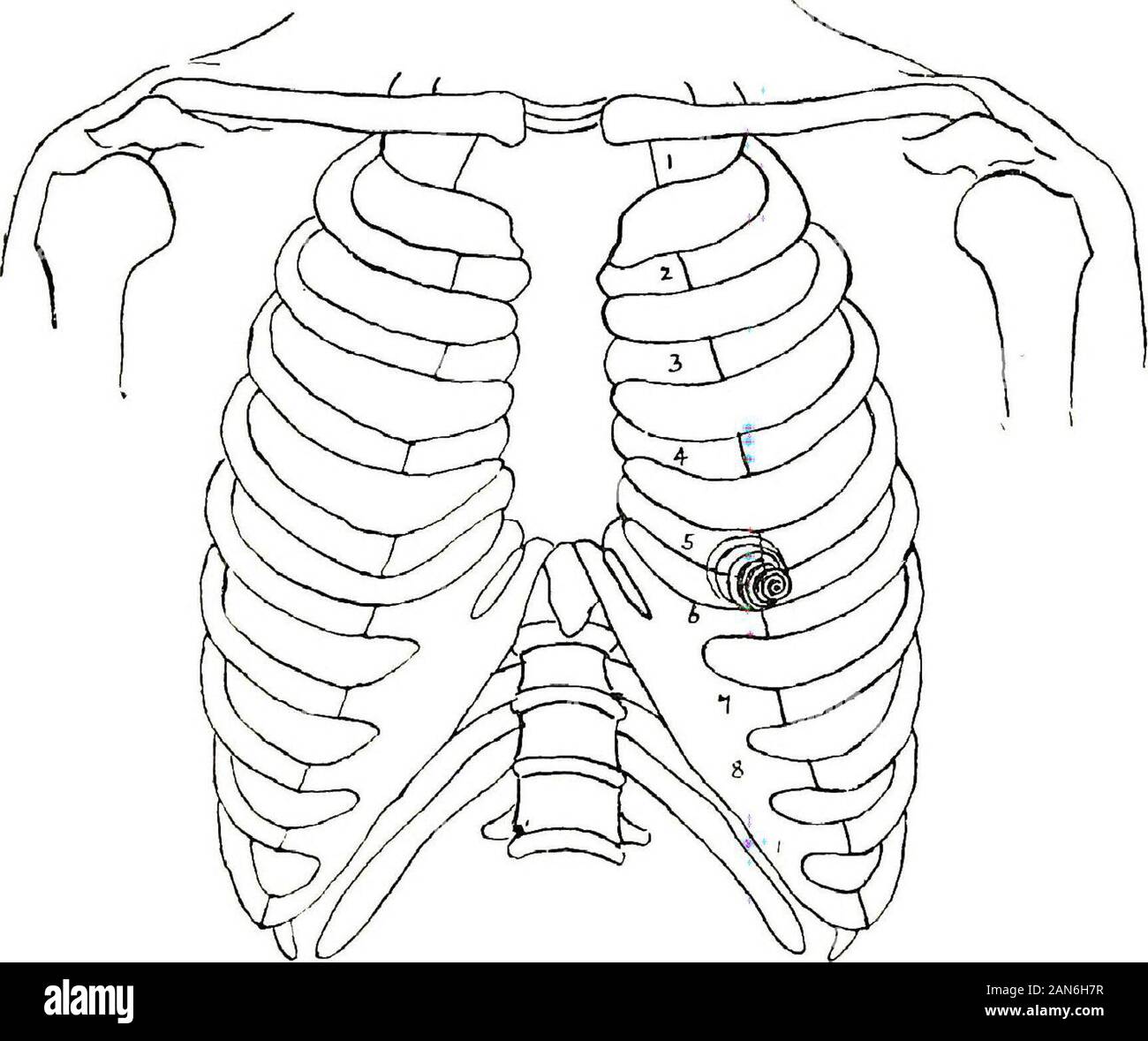Ventricular hypertrophy Cut Out Stock Images & Pictures - Alamy