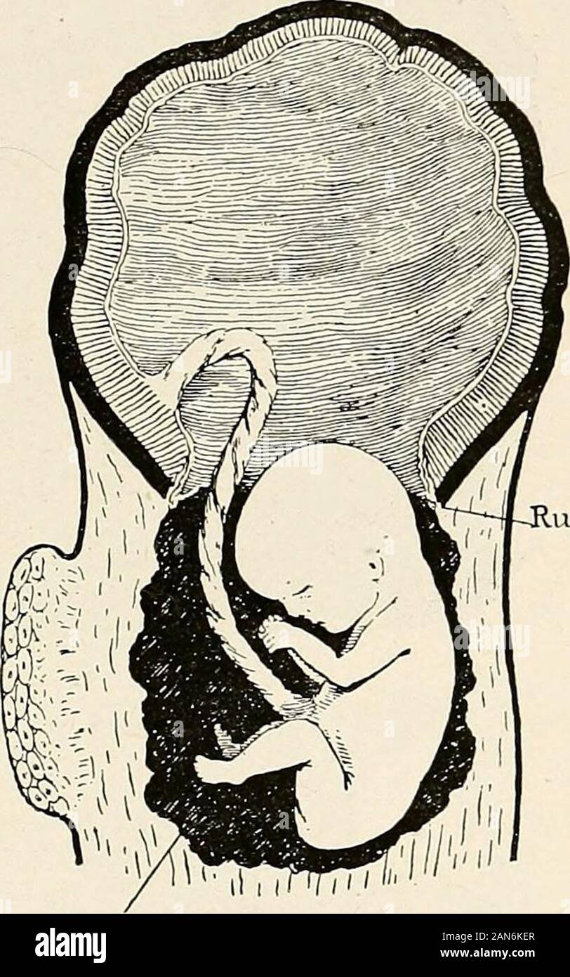 Gynaecology for students and practitioners . Gestation sac and ch-orion ...