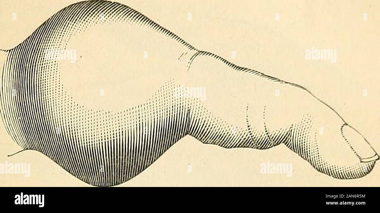 Dactylitis High Resolution Stock Photography and Images - Alamy