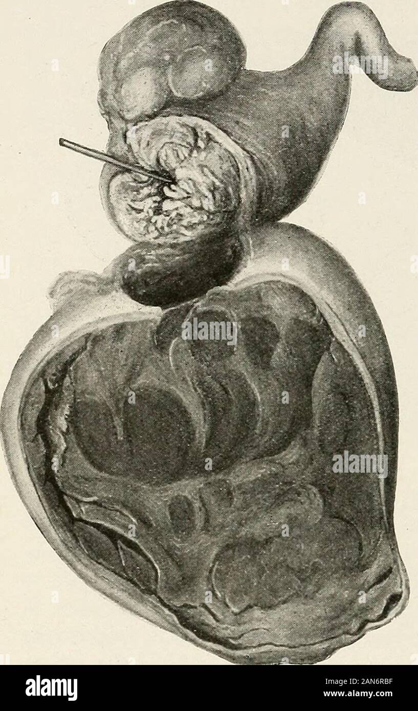 Capsular rupture hi-res stock photography and images - Alamy