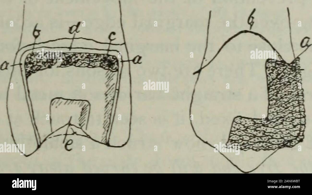 The Dental cosmos . erpendicular to Cavity- Wall and Line of Margin ...