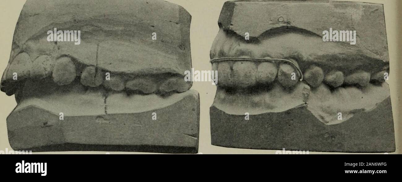 Including teeth and roof of mouth hi-res stock photography and images ...