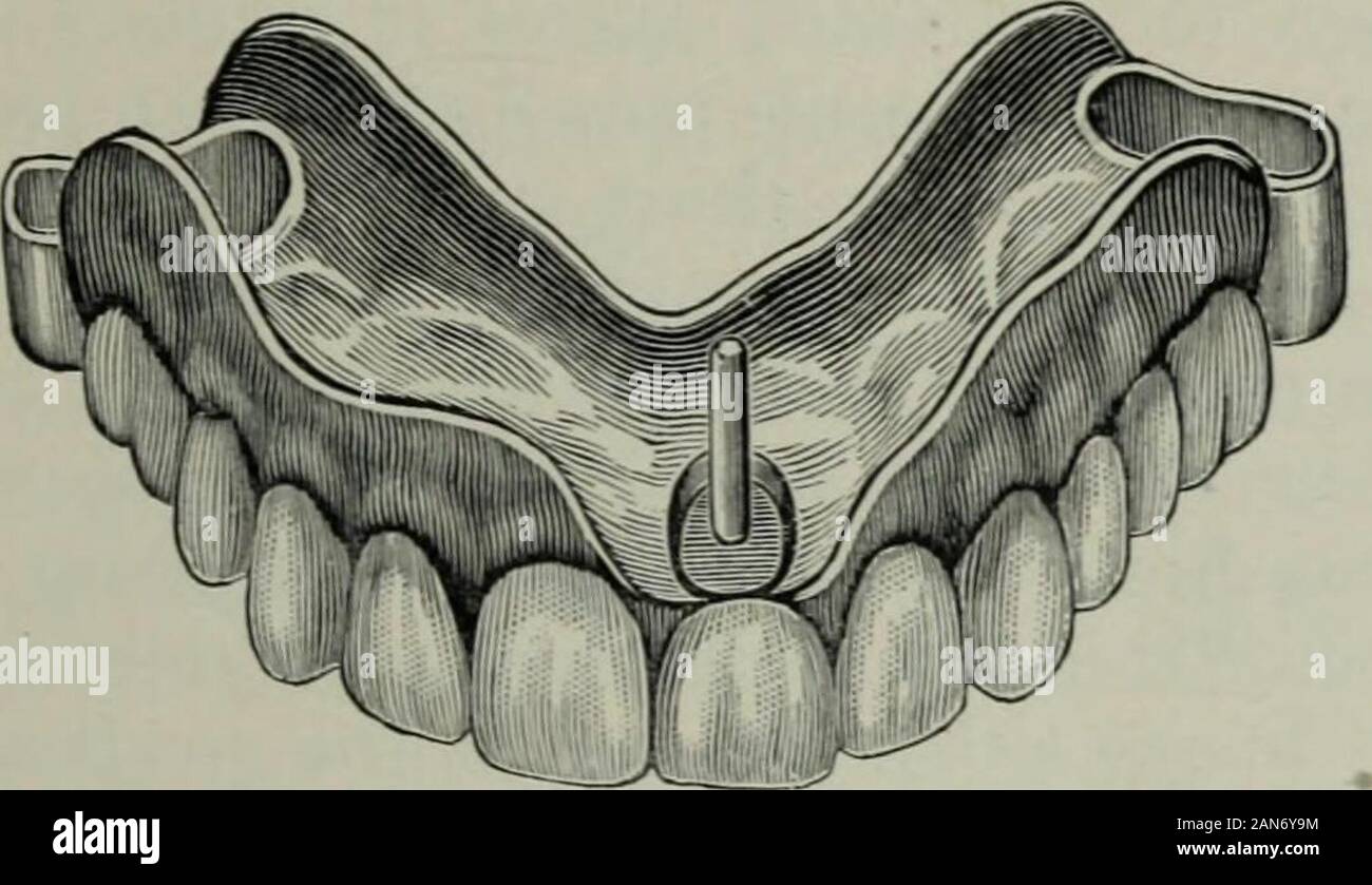 The Dental cosmos . Cast showing capped molars and cap and tubeon root ...