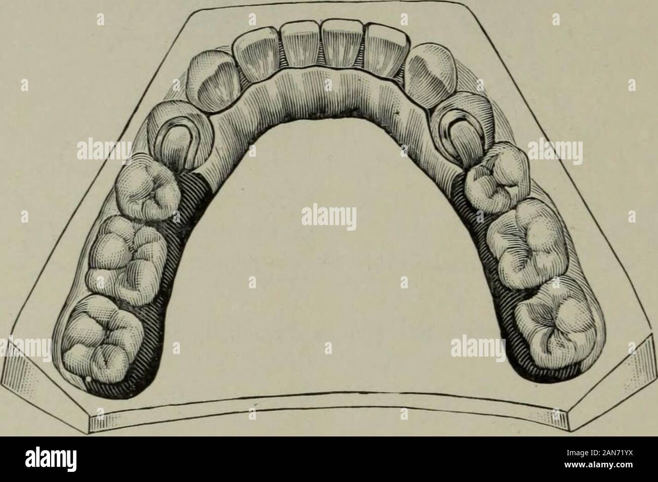 The Dental cosmos . Inlays with split pins. The inlays, d, d, restore ...