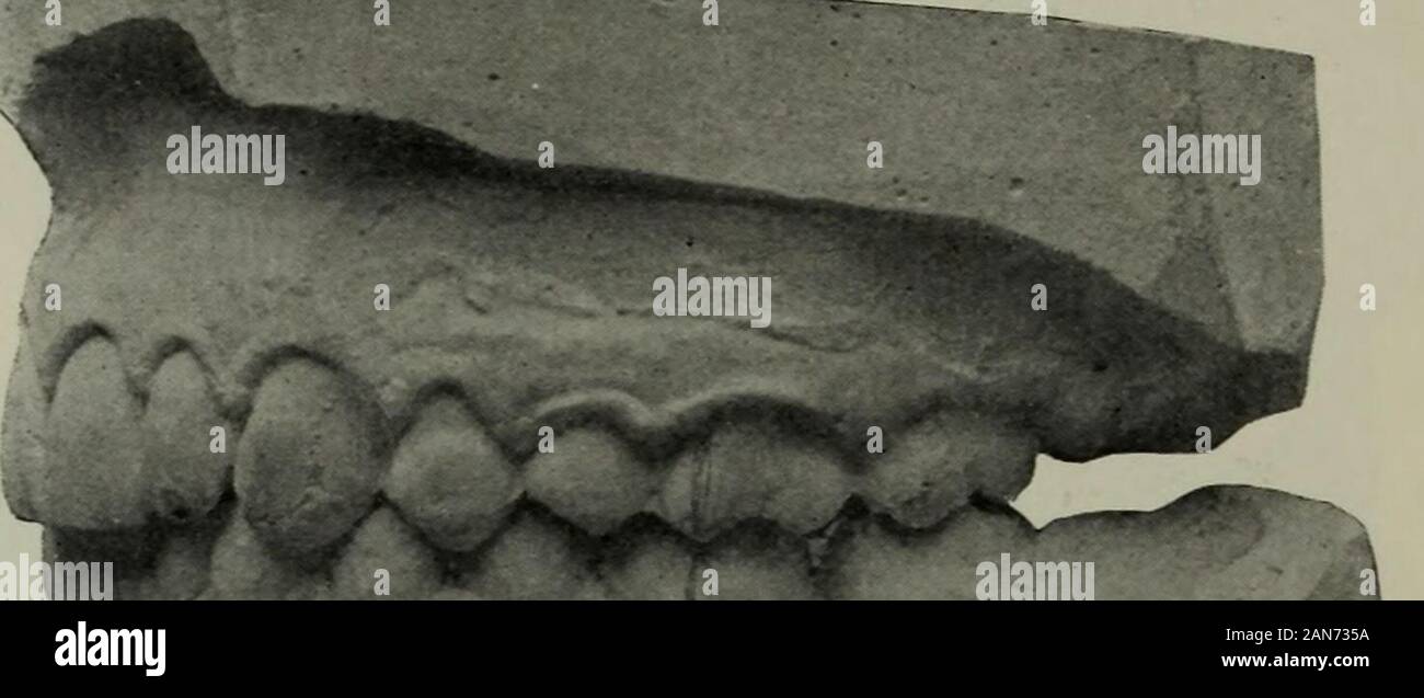 The Dental cosmos . eand size of the upper left lateral incisor.The ...