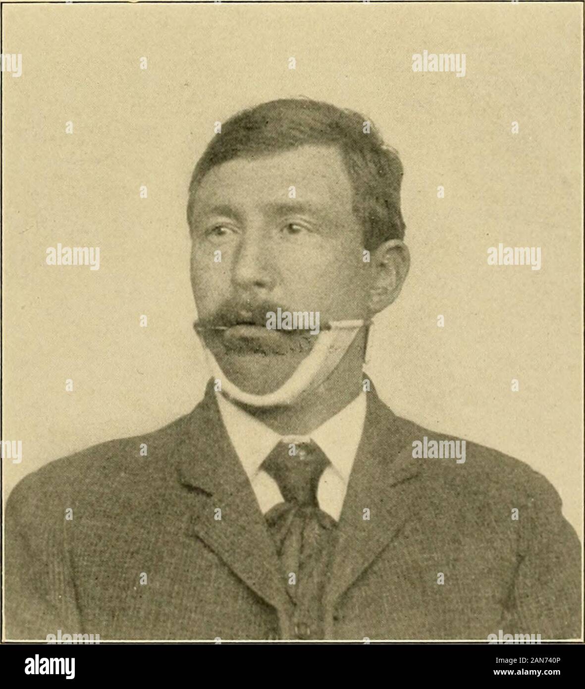 The treatment of fractures . Fig. 54.—Hard-rubber splint, with arms and ...