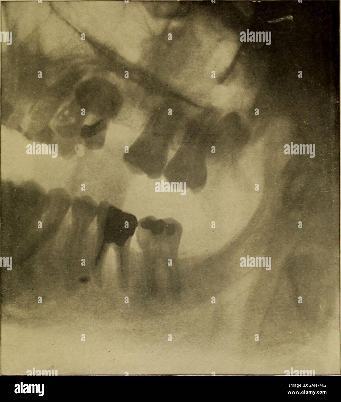 Teeth in dried jaws hi-res stock photography and images - Alamy