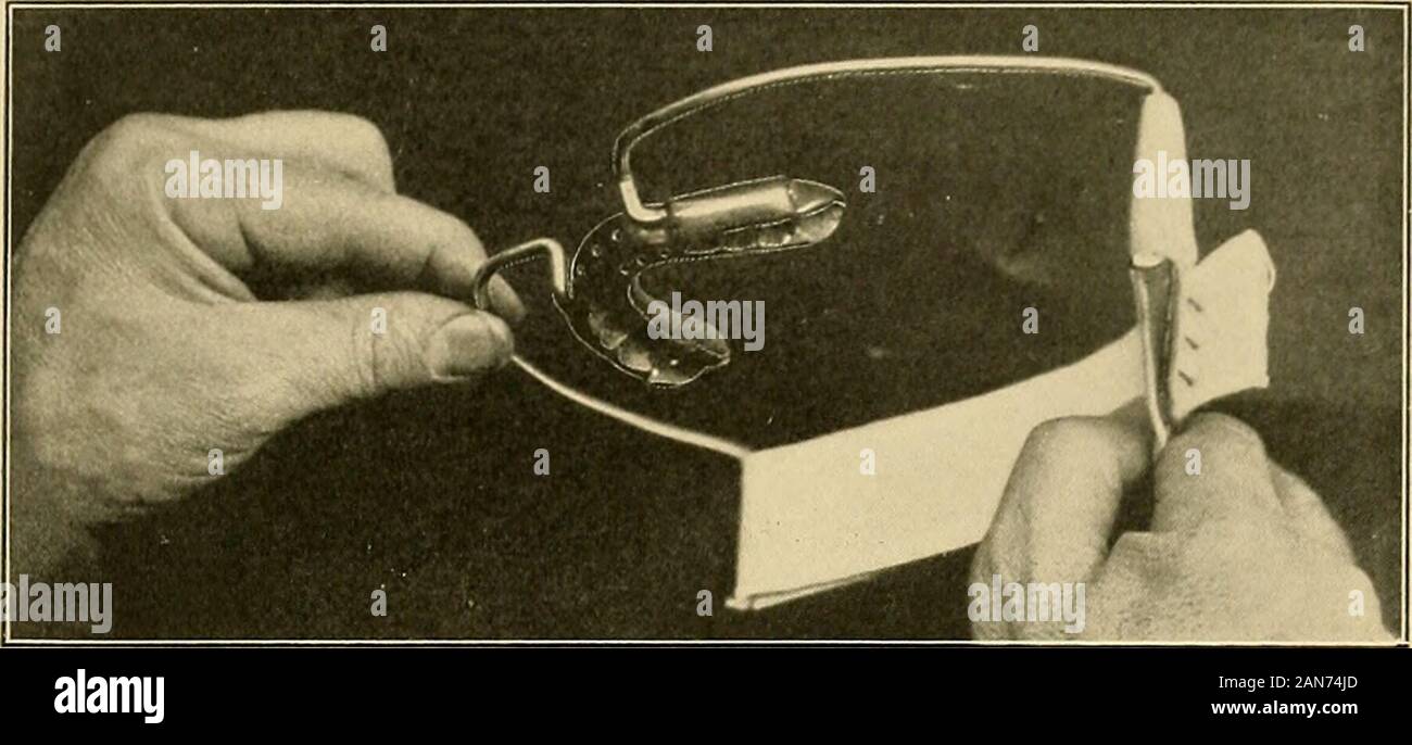 The treatment of fractures . Fig. 53.—Fracture of the lower jaw. Wiring ...