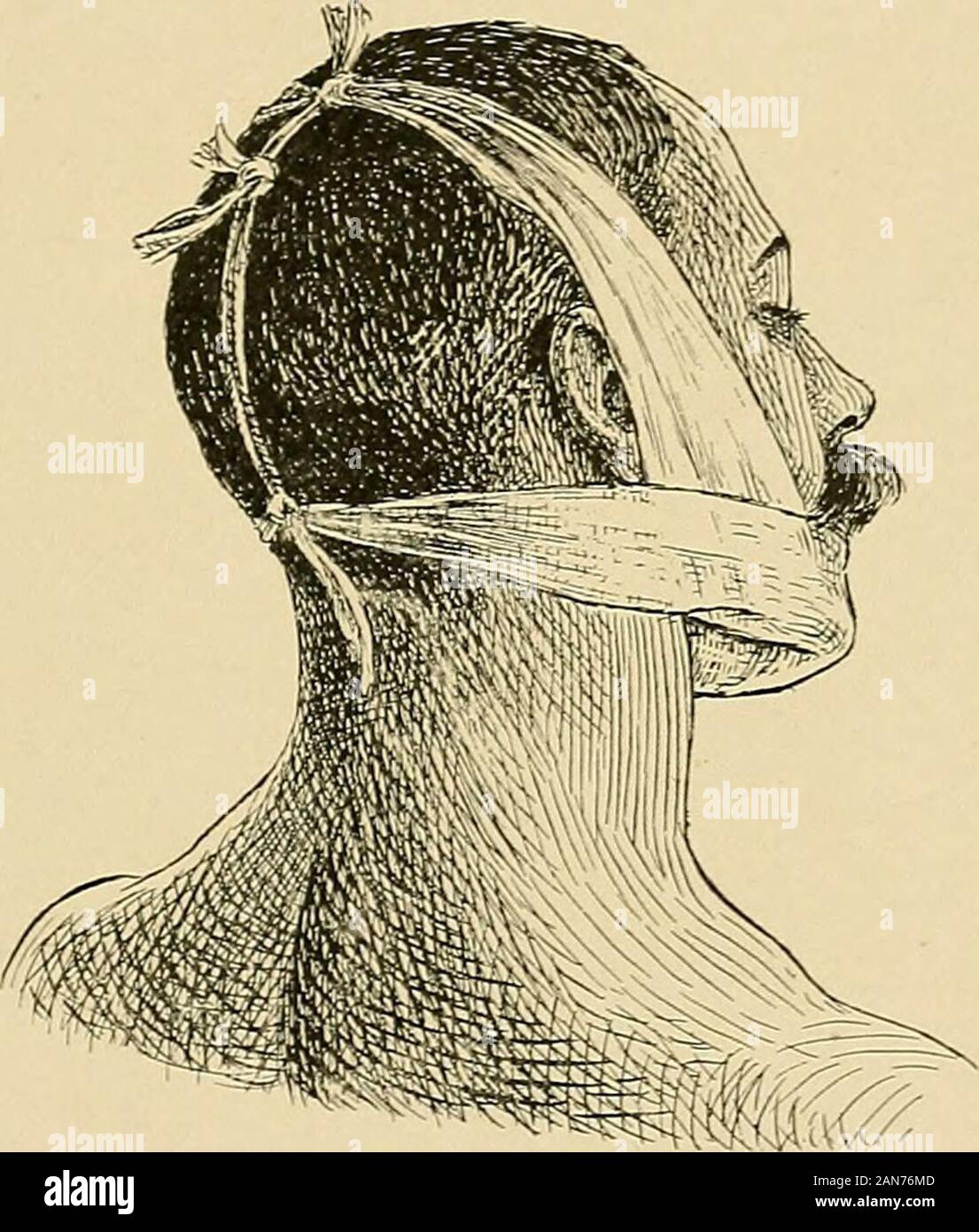 The treatment of fractures . ars. These cervical abscess--,often ...