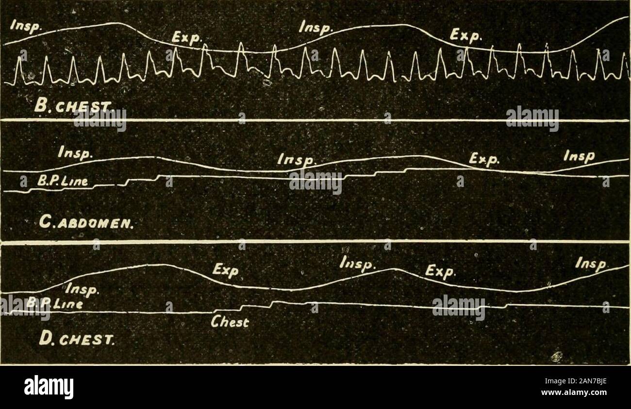 Constricted blood vessels hi-res stock photography and images - Alamy