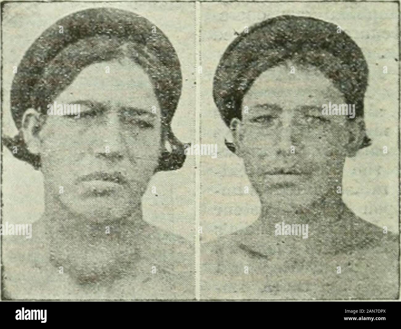 Cretinism hi-res stock photography and images - Alamy