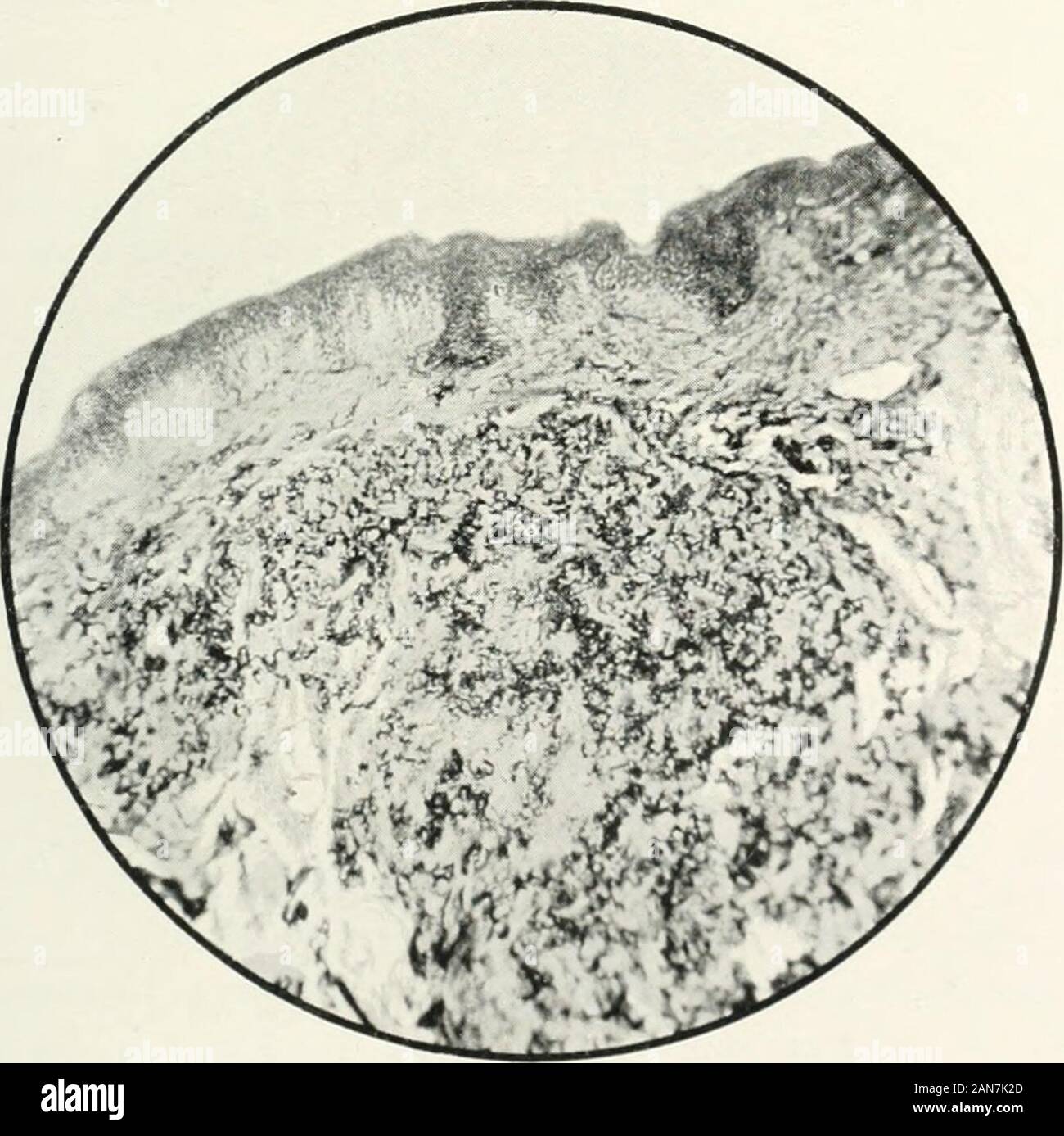 Pseudoxanthoma Elasticum Histology