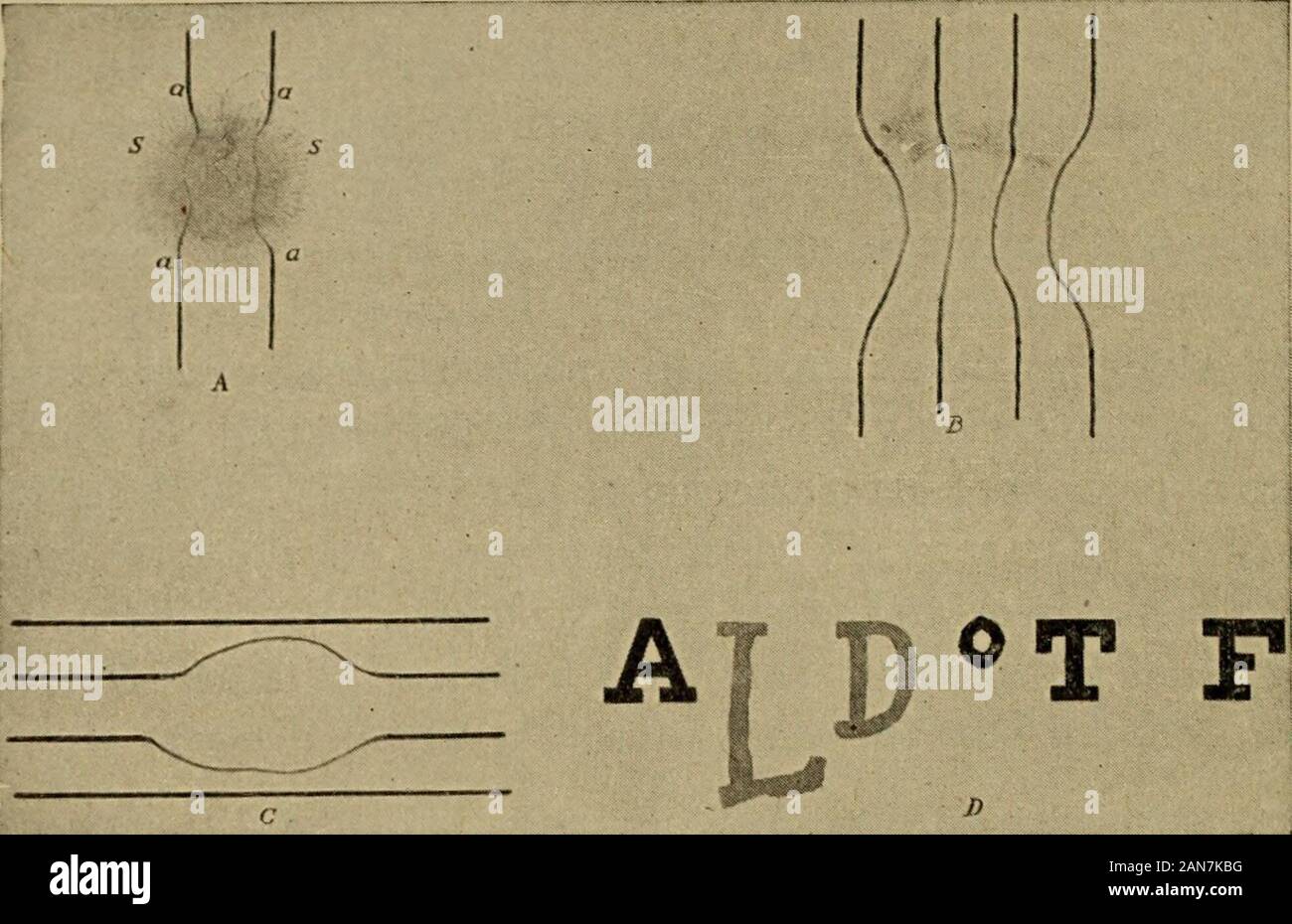 Retina detachment hi-res stock photography and images - Alamy