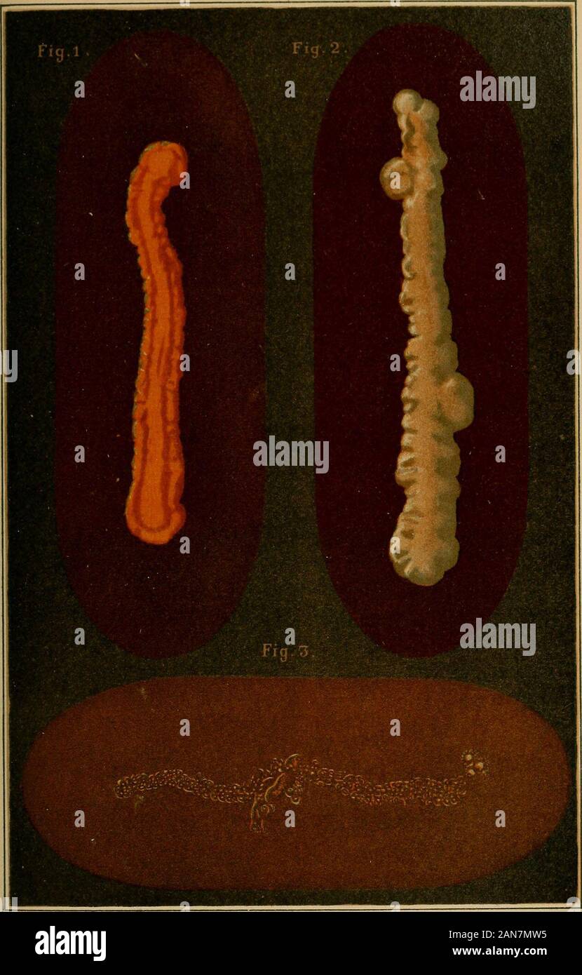 Pyaemia hi-res stock photography and images - Alamy