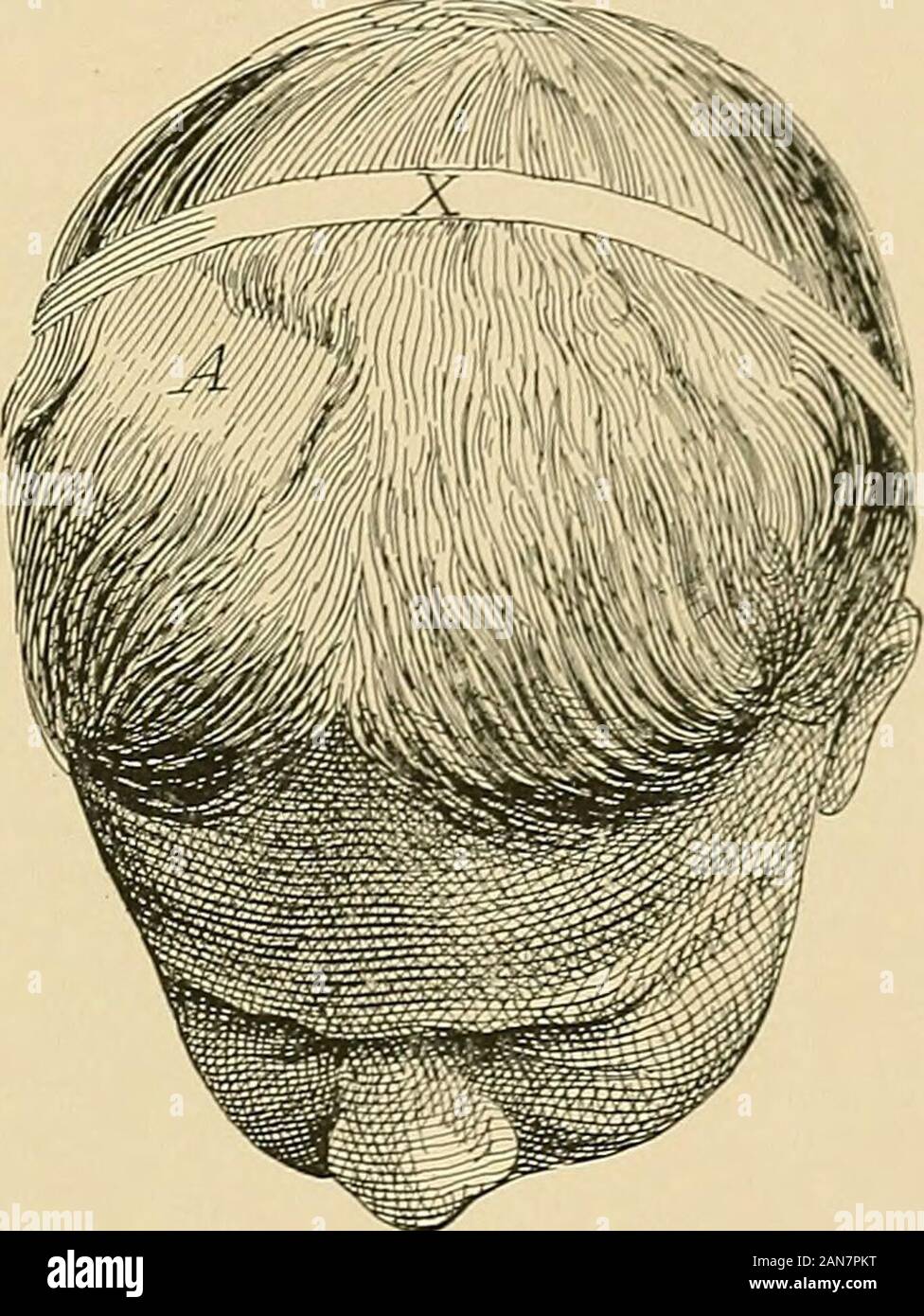 The treatment of fractures . largescalp-wound over the parietal boneand ...