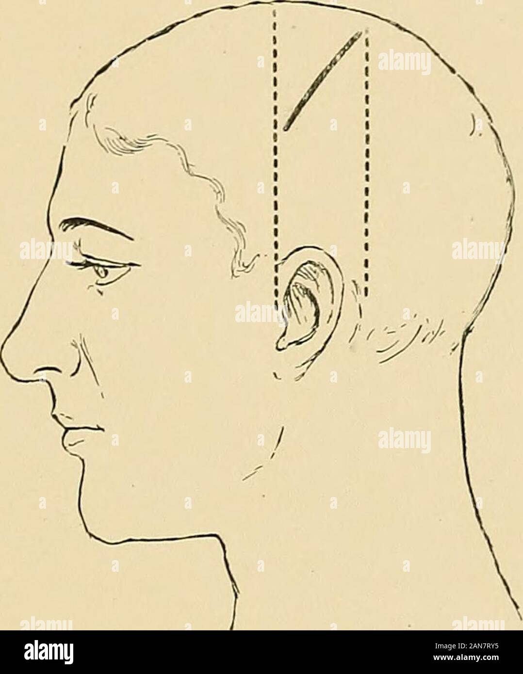 The treatment of fractures . ,a line drawn perpendicular to it will ...