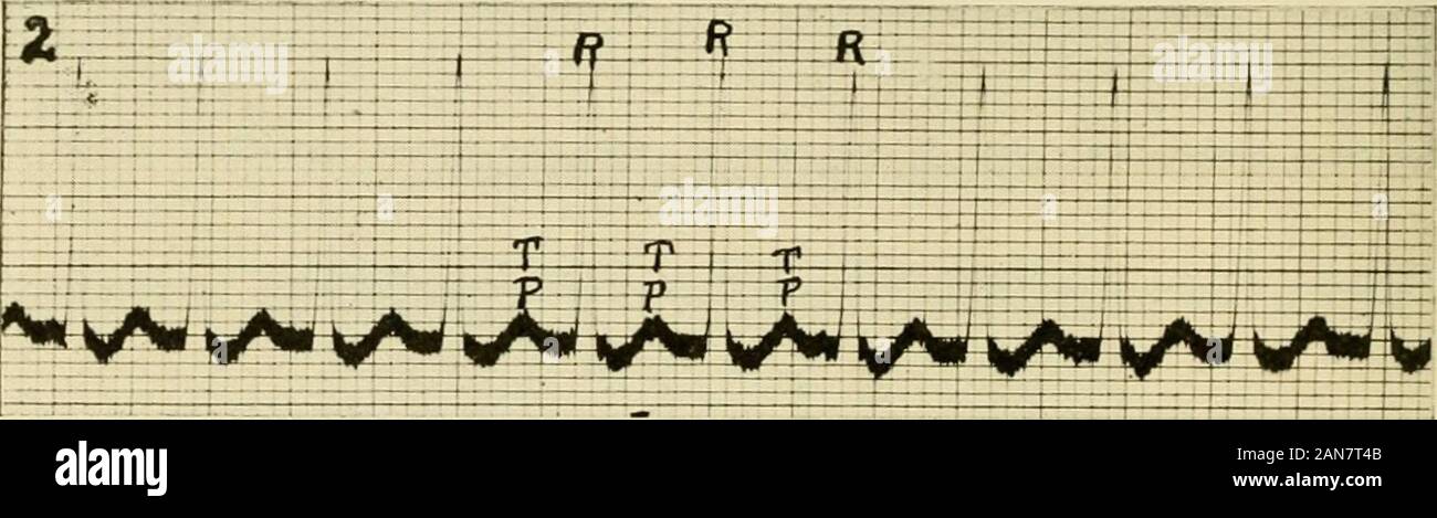 Physiology and biochemistry in modern medicine . Fig. 88.—Ventricular ...