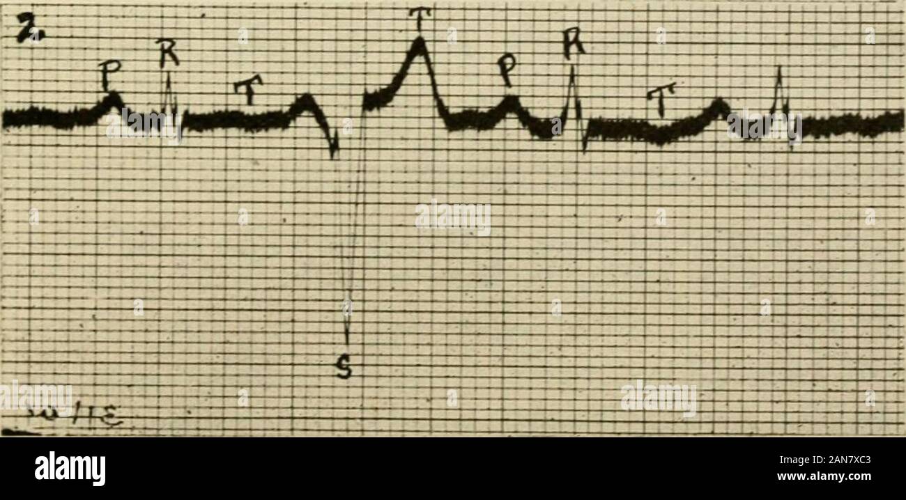 Physiology and biochemistry in modern medicine . Fig. 87.—Ventricular ...