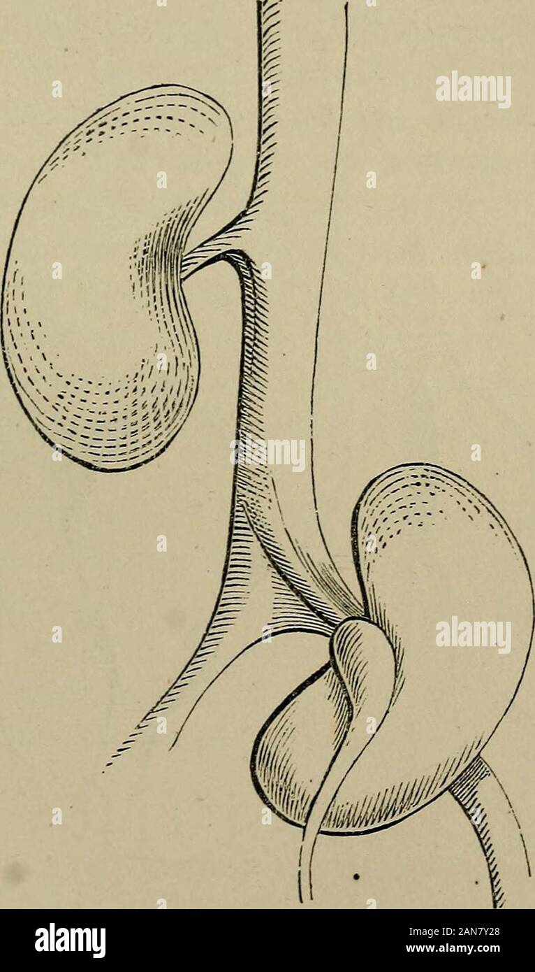 A practical treatise on urinary and renal diseases : including urinary ...