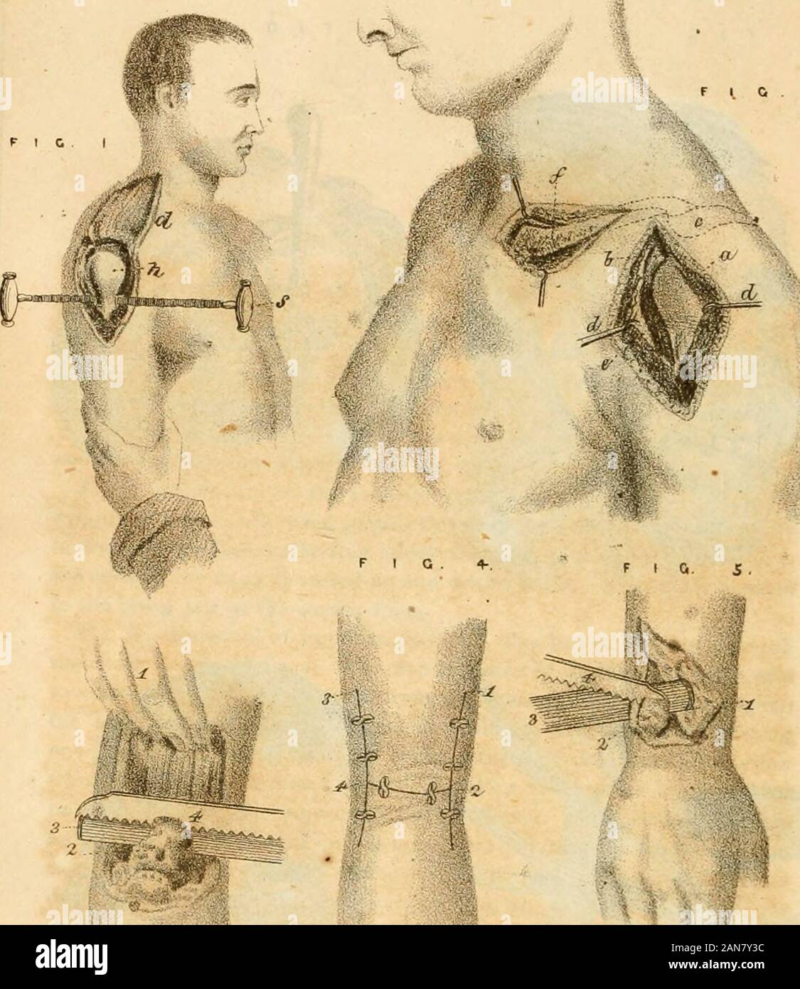 Shoulder clavicle resection hi-res stock photography and images - Alamy