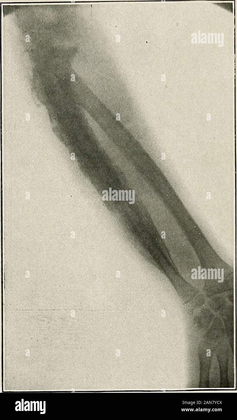 Bismuth paste in chronic suppurations, its diagnostic importance and ...
