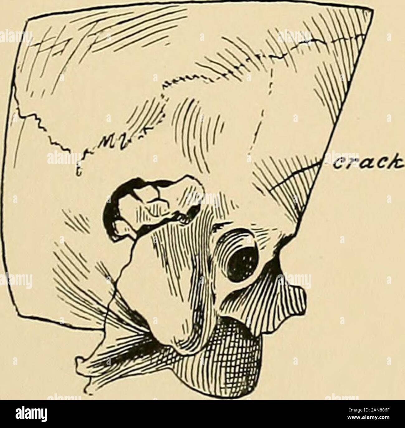 The treatment of fractures . Cribriform plate, foraminafor olfactory ...