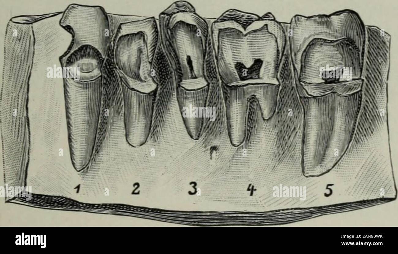 The Dental cosmos . approximal surface so asto expose the dentin; two ...