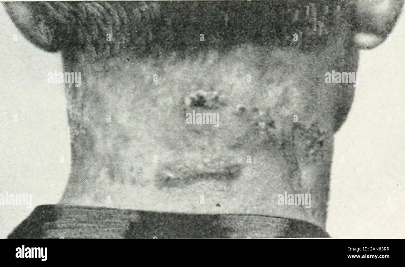 The British journal of dermatology . Fig. 12.—Photograph ot a man. aged ...