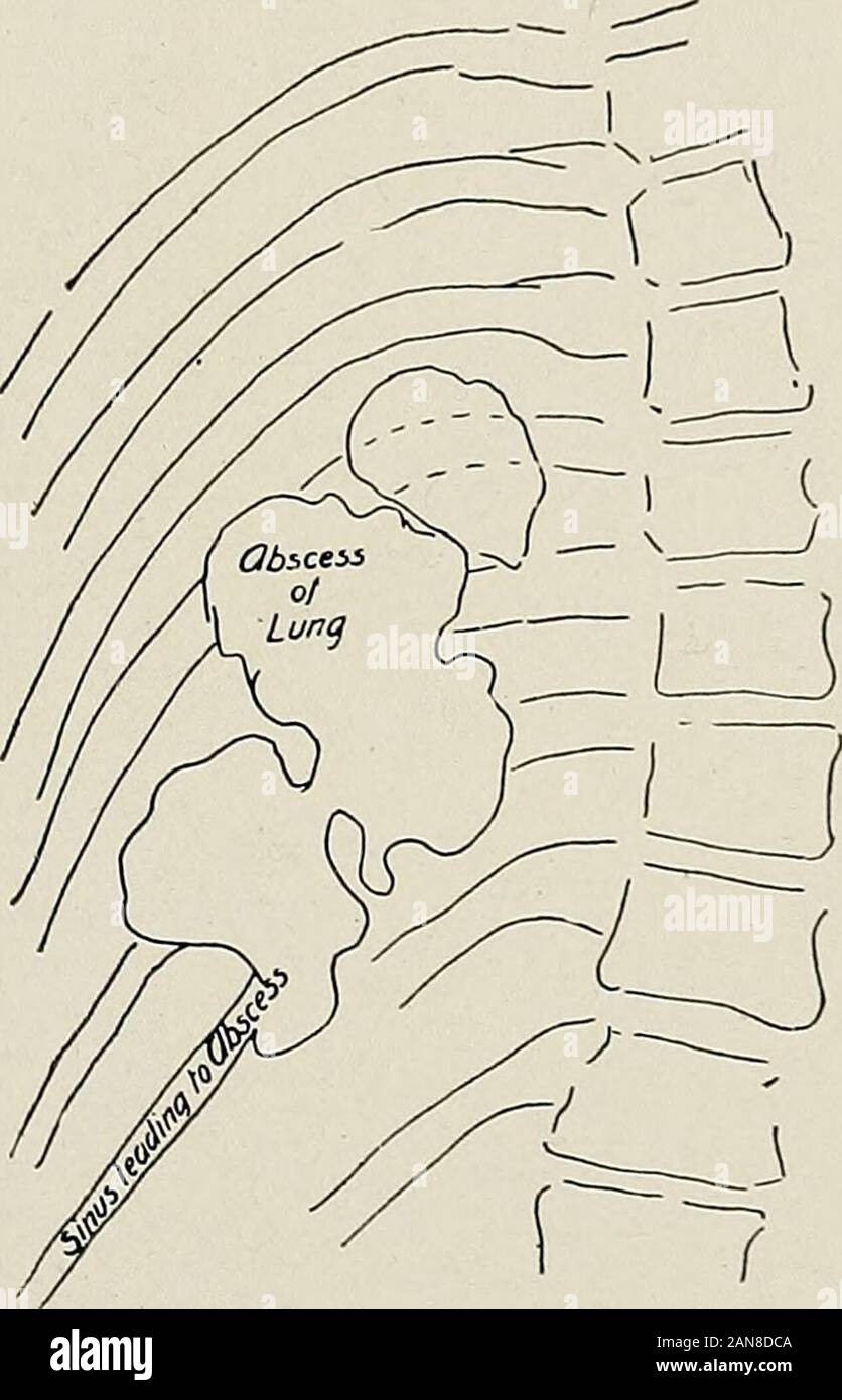 Bismuth paste in chronic suppurations, its diagnostic importance and ...