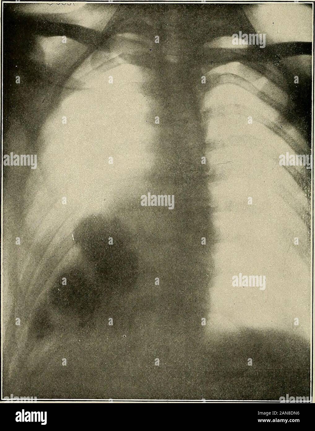 Bismuth paste in chronic suppurations, its diagnostic importance and ...