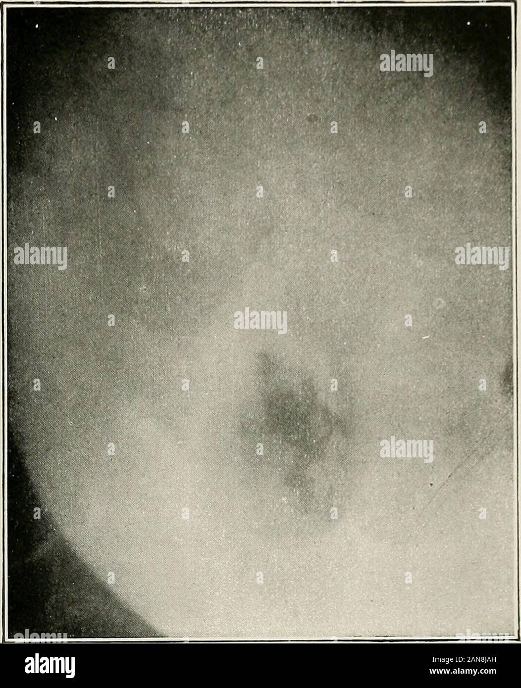 Bismuth paste in chronic suppurations, its diagnostic importance and ...