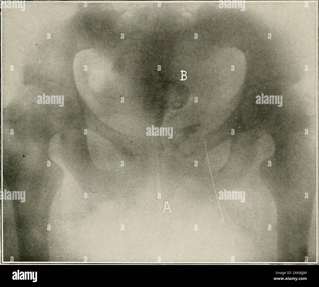 Dermoid cyst hi-res stock photography and images - Alamy