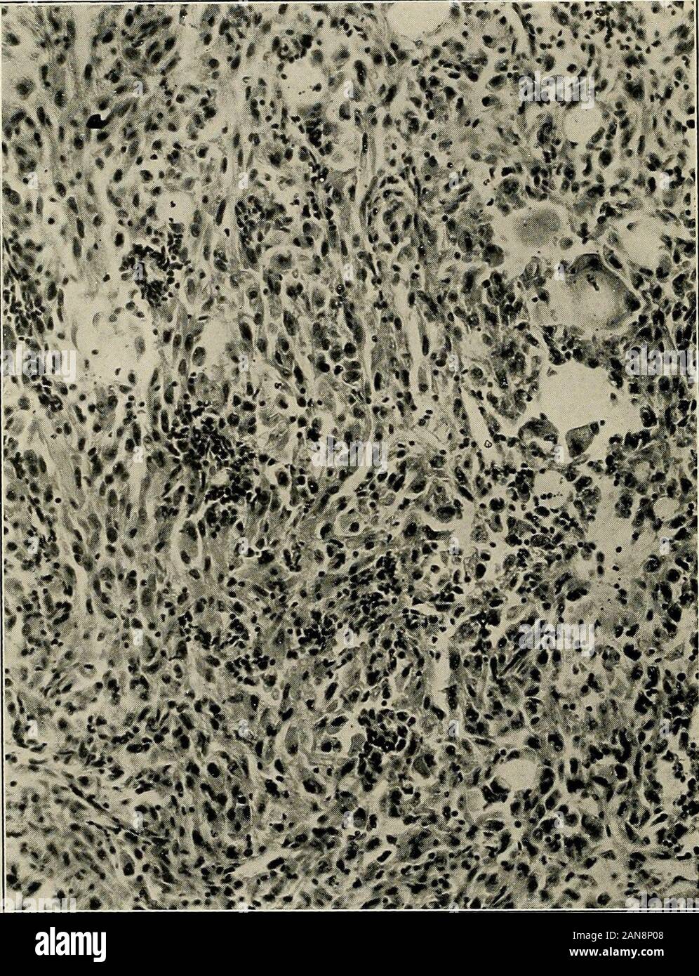 Sarcomatous tissue hi-res stock photography and images - Alamy