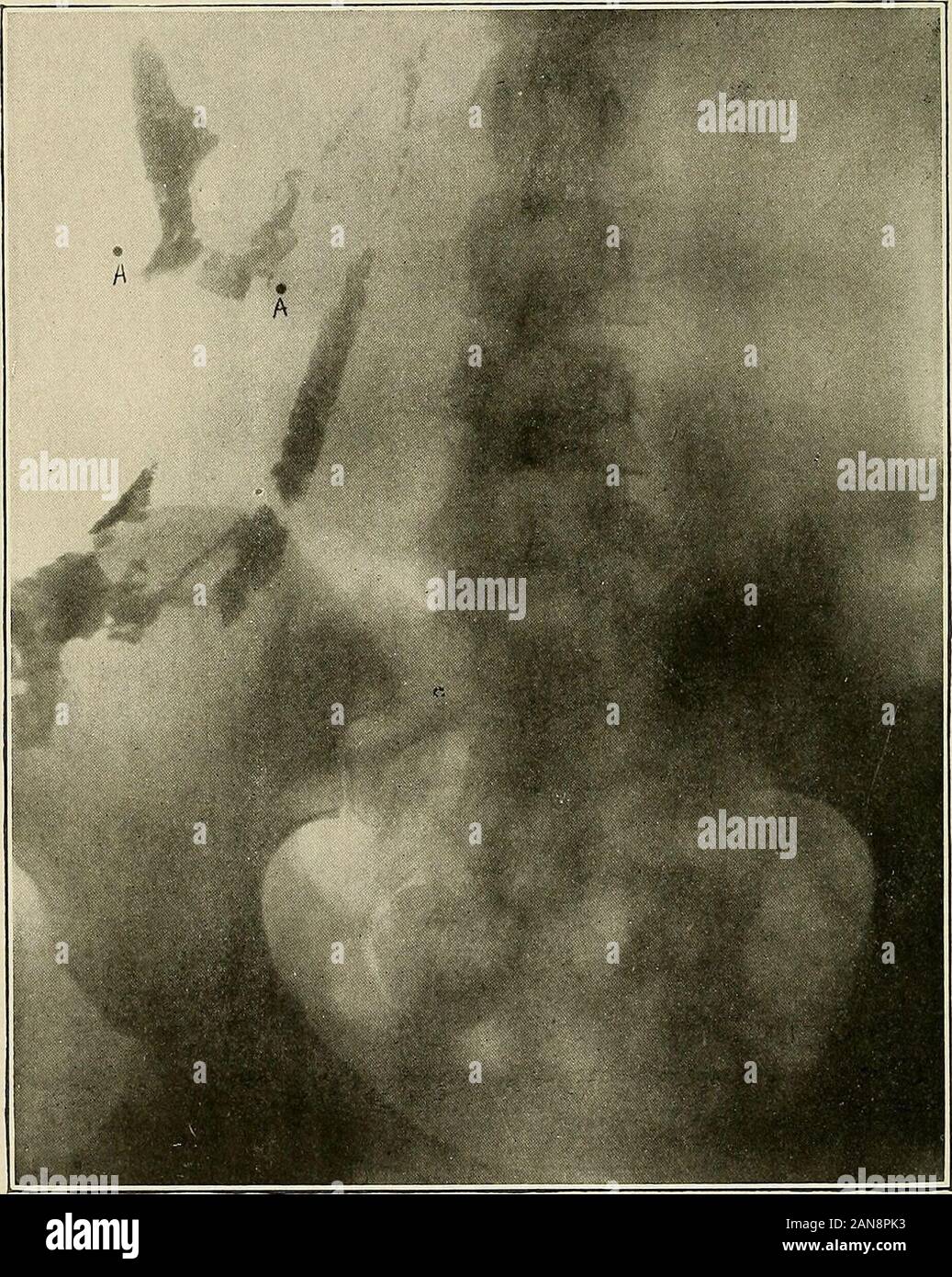 Bismuth paste in chronic suppurations, its diagnostic importance and ...
