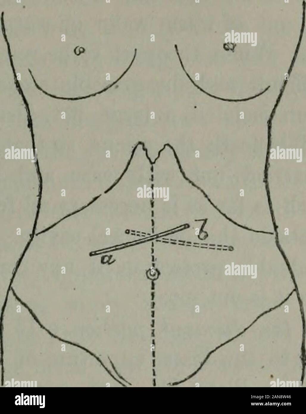 Surgical incision bleeding hi-res stock photography and images - Alamy