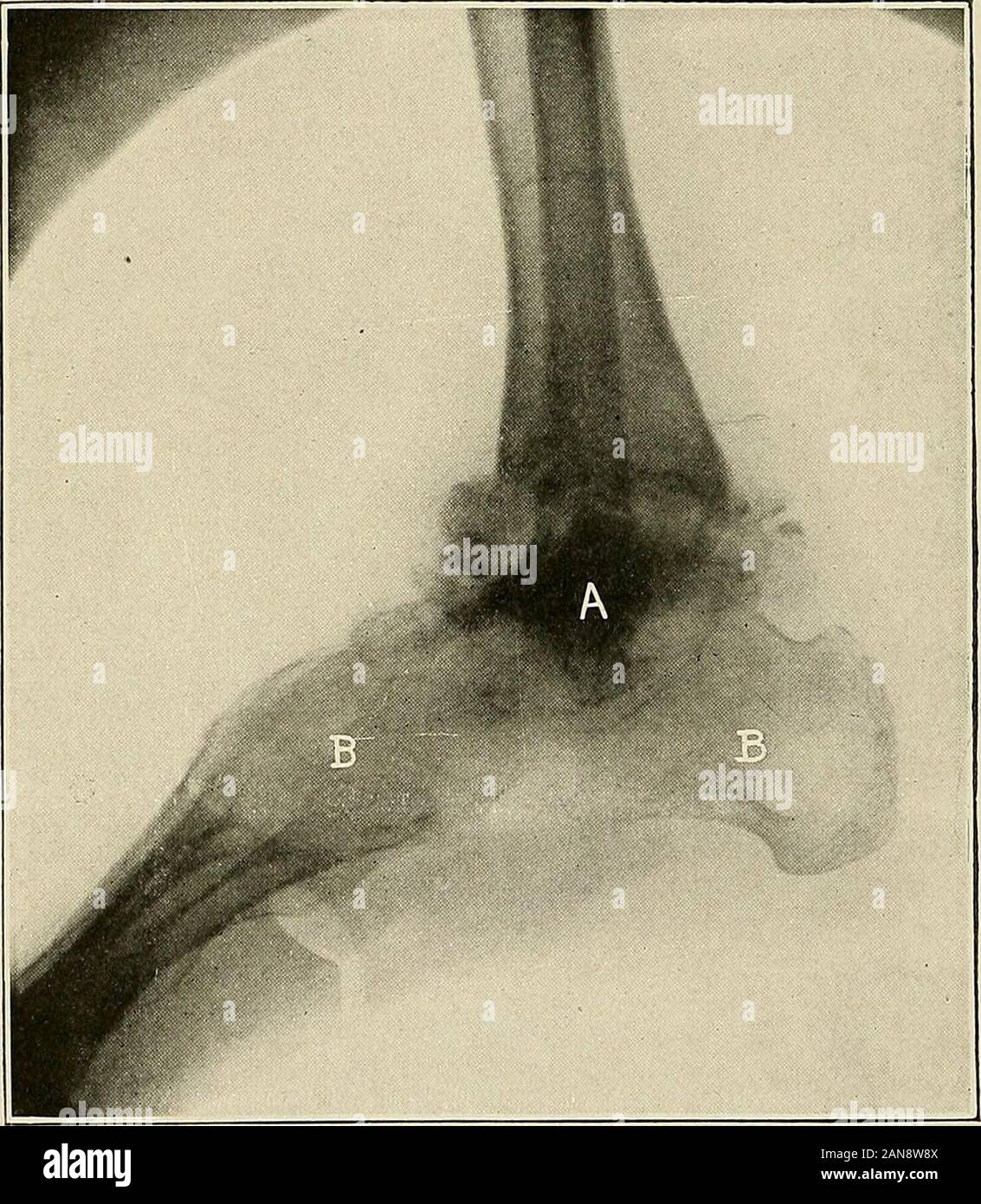 Bismuth paste in chronic suppurations, its diagnostic importance and ...