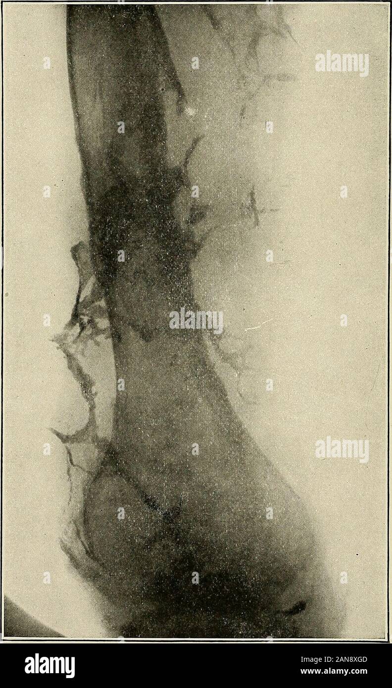 Bismuth paste in chronic suppurations, its diagnostic importance and ...