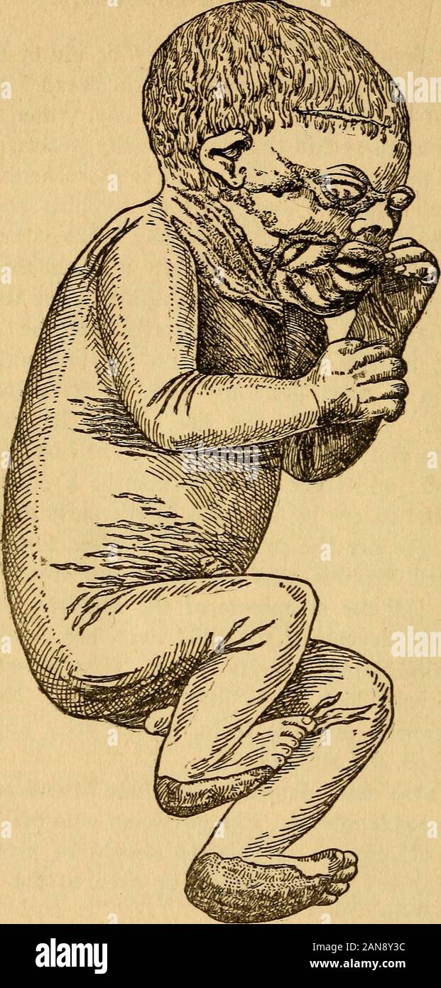 Rhagades hi-res stock photography and images - Alamy
