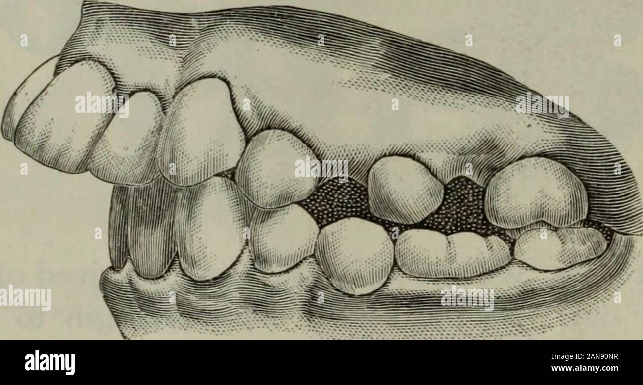 The Dental cosmos . d Arch. When from a want of harmony between the ...