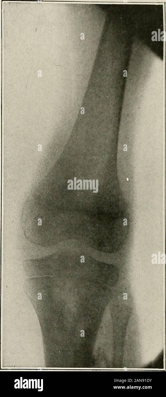 Bismuth paste in chronic suppurations, its diagnostic importance and ...