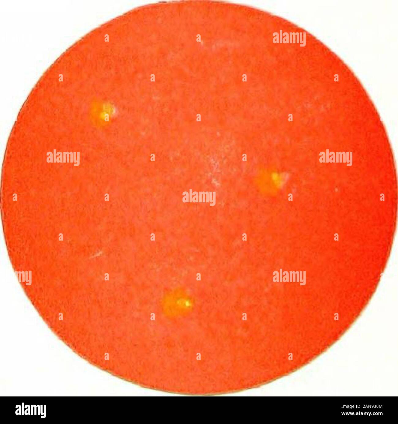 Koplik's spots hi-res stock photography and images - Alamy